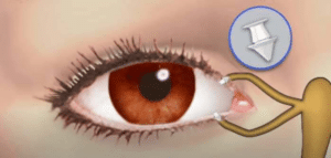 Punctal Plugs: How They Help With Dry Eye Syndrome